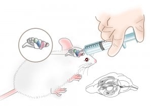 Intraventicular Administration – Clodrosome: Liposomal Clodronate