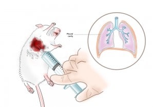 Intrapleural Administration – Clodrosome: Liposomal Clodronate